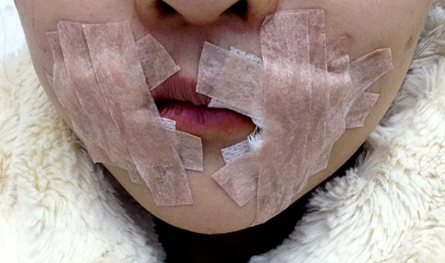 Smile lift Surgery | Lip corner surgery | Smile lipt surgery | Korean ...