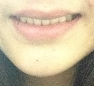 Korean Smile lipt | Smile lift Surgery Korea | Korea plastic surgery