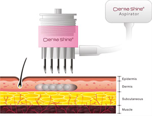 Korean Derma Shine Injection | Aqua Shining Injection Review | Korea ...