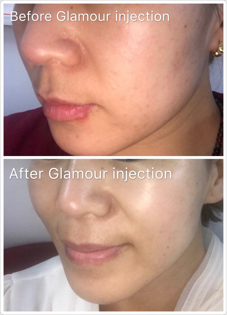 Skin Booster Mesh Cross linked hyaluronic acid filler Injection 3 in 1 ...