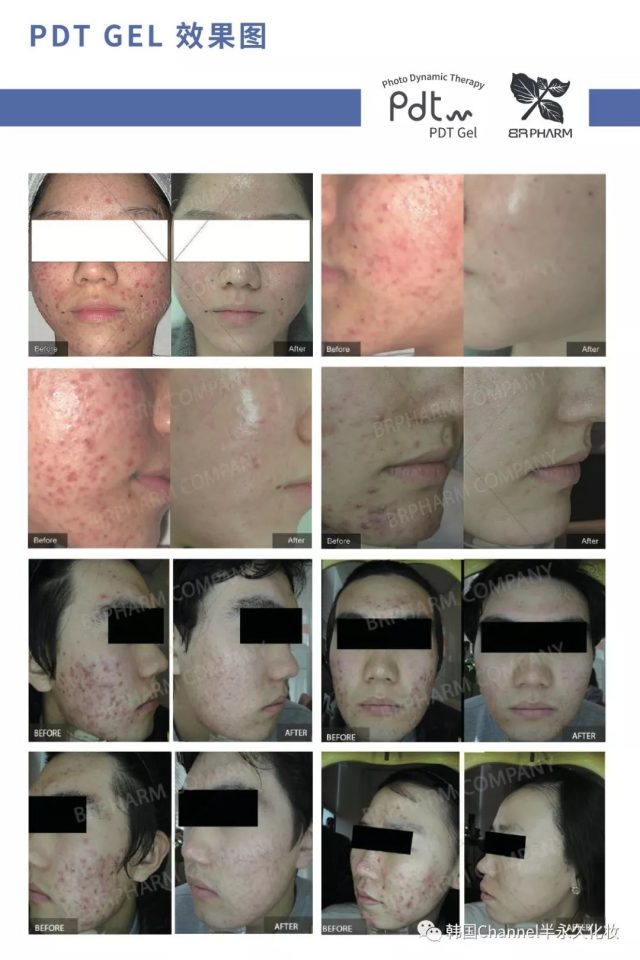 PDT GEL Archives | Wassup Apgujeong Korean Skin Care Reviews