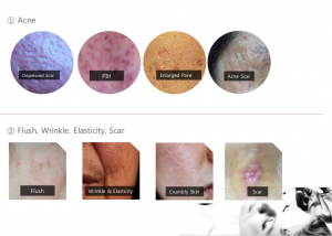 Laser is not the only acne scar removal method, try PDRN skin healer