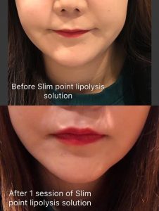 Venus Edge 6D Slim Point Lipodissolve injection by Daese Meditech ...