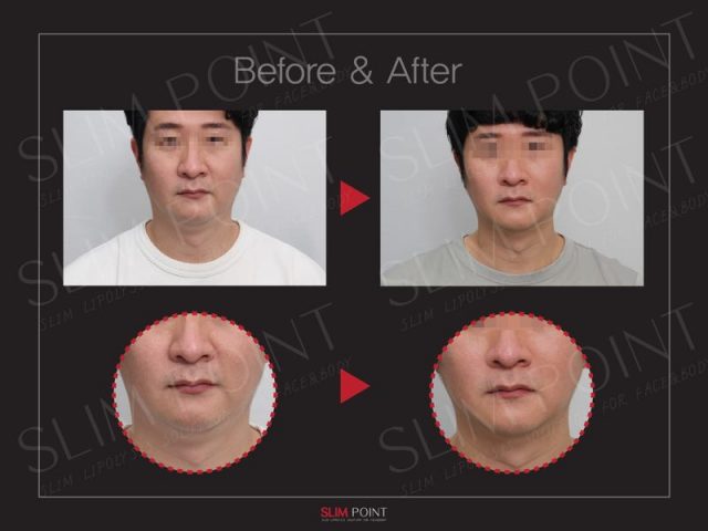 New lipodissolve solution Slim Point Lipolysis Injection compares to ...