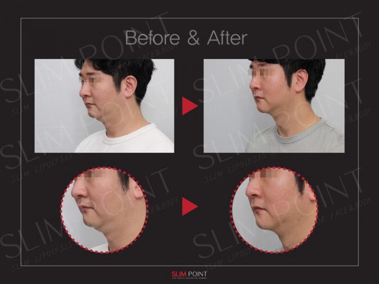 New lipodissolve solution Slim Point Lipolysis Injection compares to ...