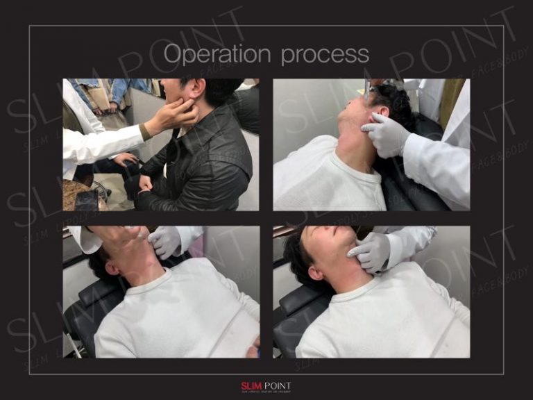 New lipodissolve solution Slim Point Lipolysis Injection compares to ...