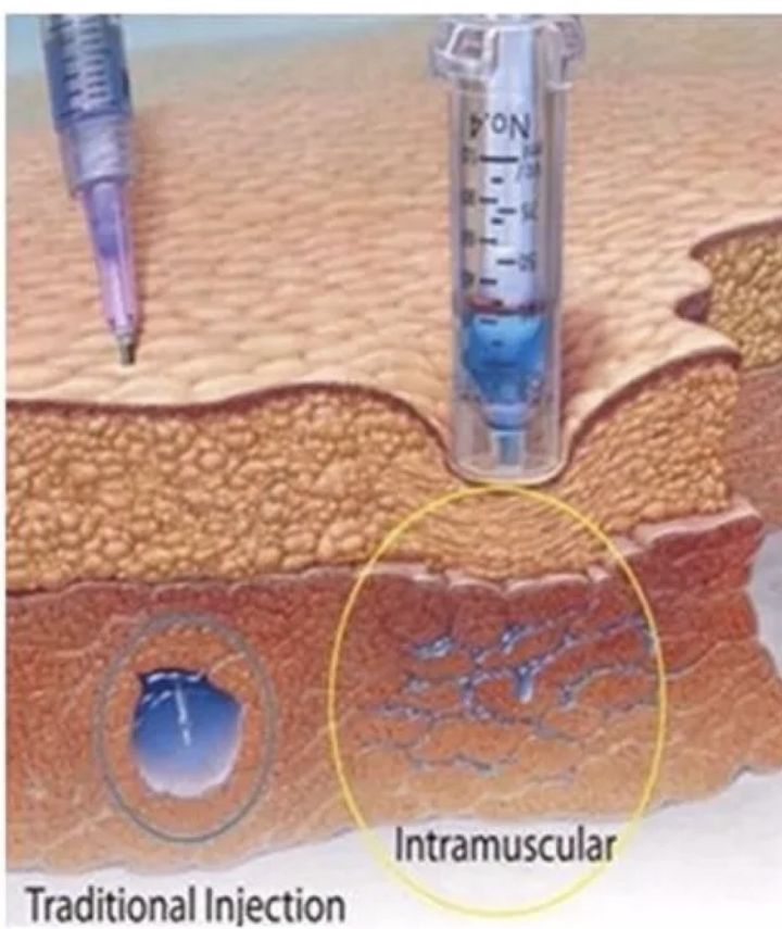 How to choice the best hyaluronic acid for Hyaluron Pen needle free ...